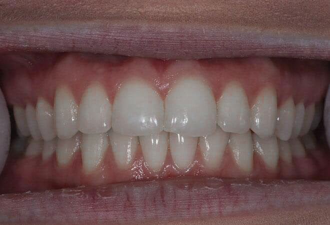 Virtual Consult - Kinetic Braces