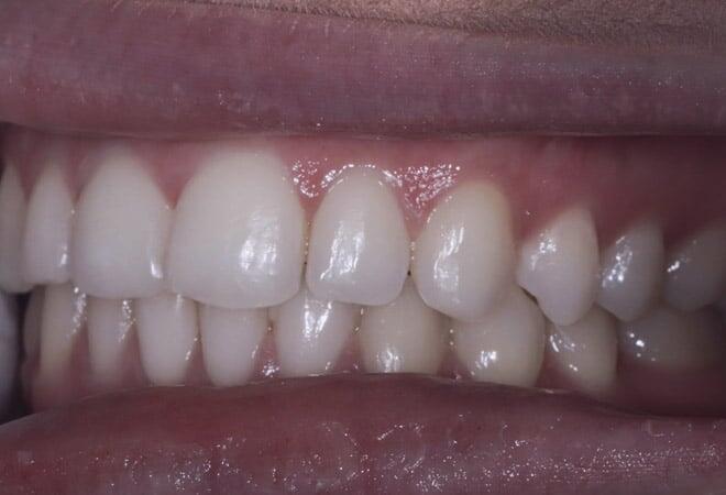 Virtual Consult - Kinetic Braces