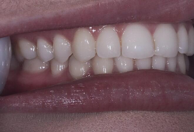 Virtual Consult - Kinetic Braces