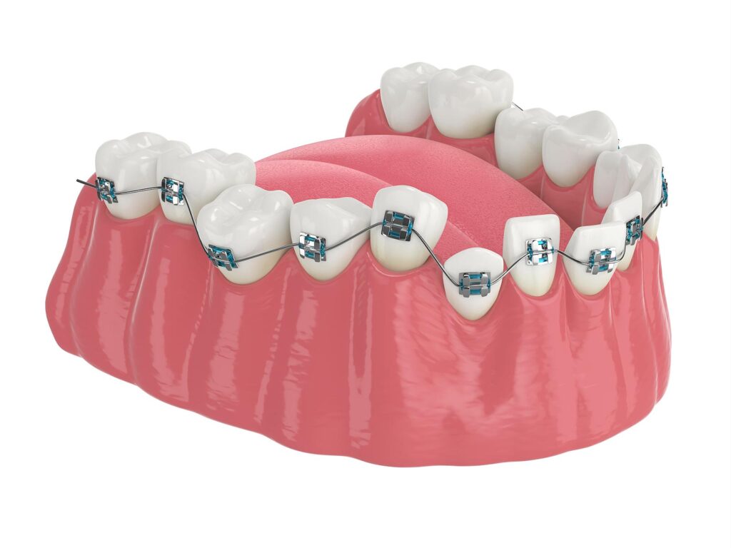 Braces In Kansas City, MO - Kinetic Braces