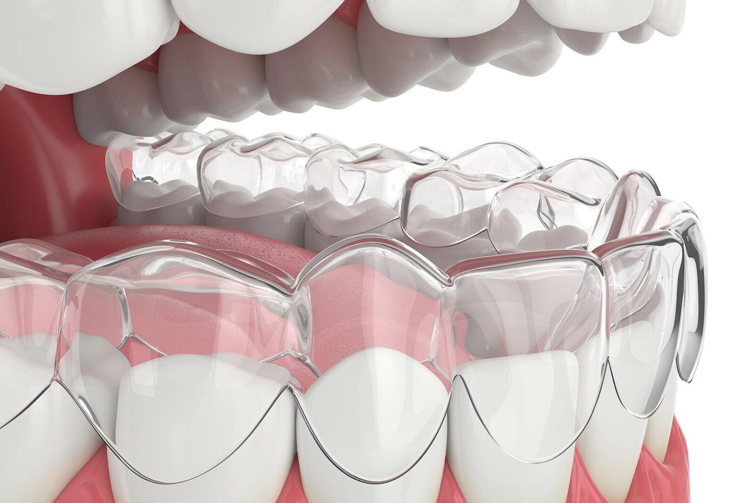 Invisalign For Adults In Kansas City, MO - Kinetic Braces